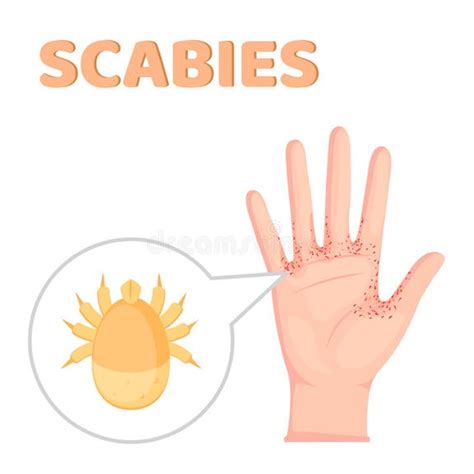 Sarcoptes Scabiei Scabies Sexually Transmitted Disease Infographics