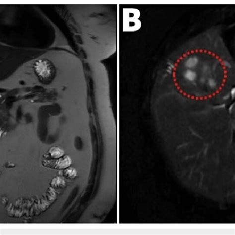 Mri Of The Abdomen And Pelvis Mri Of The Abdomen And Pelvis A Download Scientific Diagram