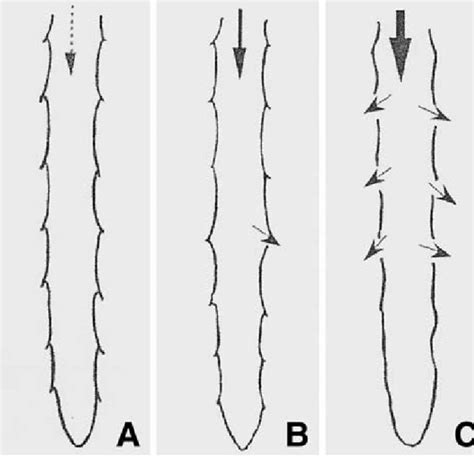 Hypothetical Schema Of Spreading Disruption Of The Arachnoid Membrane
