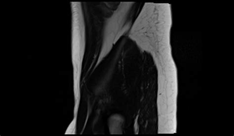 Appendix Mri T2 Tse Sagittal Images