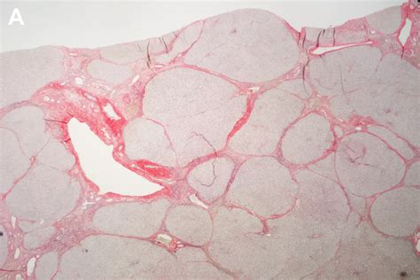 Nyps 2017 Beijing Classification Ppt