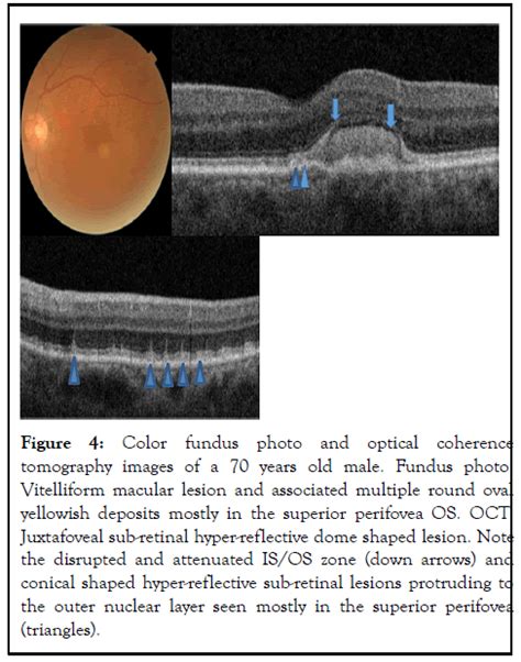 Pseudo Vitelliform Dystrophy