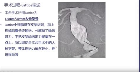 高歌教授：lattice血流导向密网支架临床使用体会 脑医汇