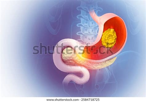 Stomach Cancer Gastric Cancer Symptoms Stages Stock Illustration