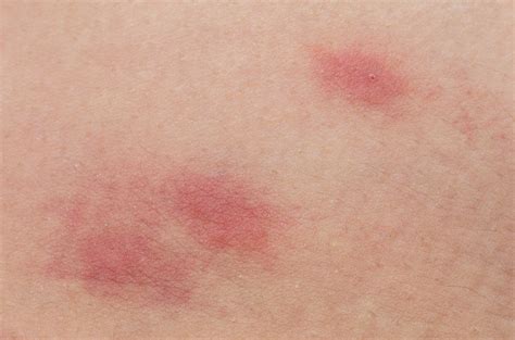What Do Flea Bites Look Like On Humans Natran Green Pest Control