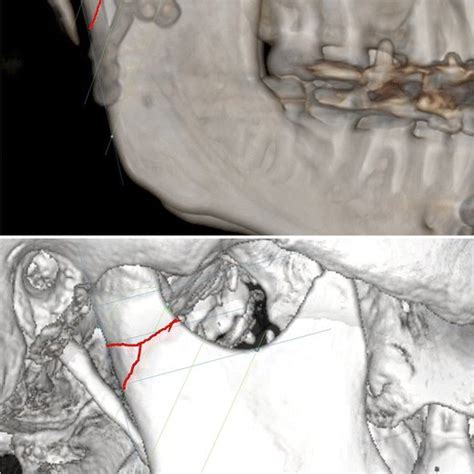 The Modification Of The Classification Of Mandible Condyle Fractures Download Scientific