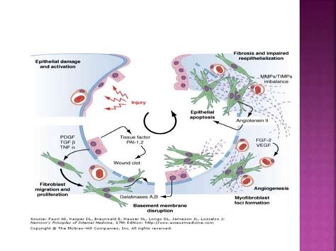 Interstitial Pulmonary Fibrosis Pptx Lung And Respiratory Health