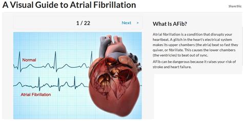 Health Is Wealth Atrial Fibrillation A Powerpoint Presentation By Webmd