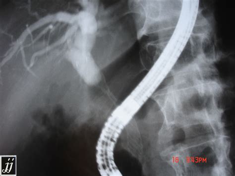Ercp And Mrcp Radiopaedia