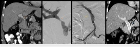 60 Year Old Patient With A History Of Orthotopic Liver Transplant Due