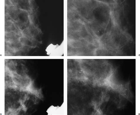Calcifications Small Roundpunctate Radiology Key