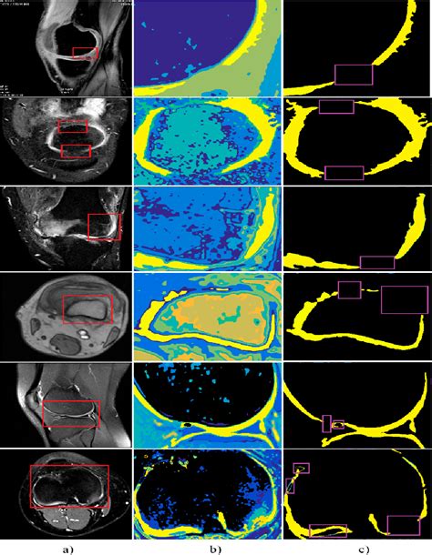 Figure 11 From Segmentation Of Articular Cartilage And Early