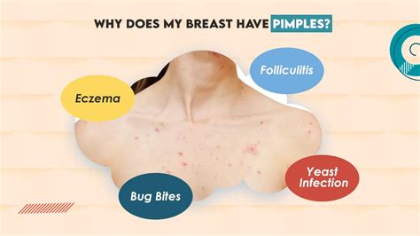 What Causes Pimple On Breast Is It Breast Cancer Happy Cappy