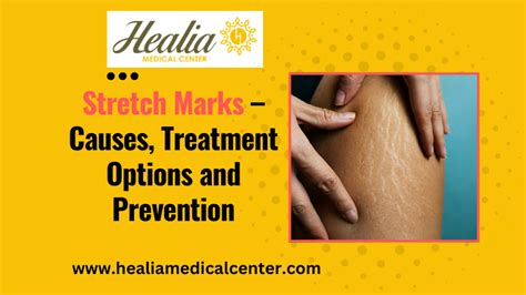Stretch Marks Causes Treatment Options And Prevention Healia