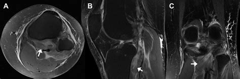 Posterolateral And Posteromedial Corner Injuries Of The Knee Magnetic