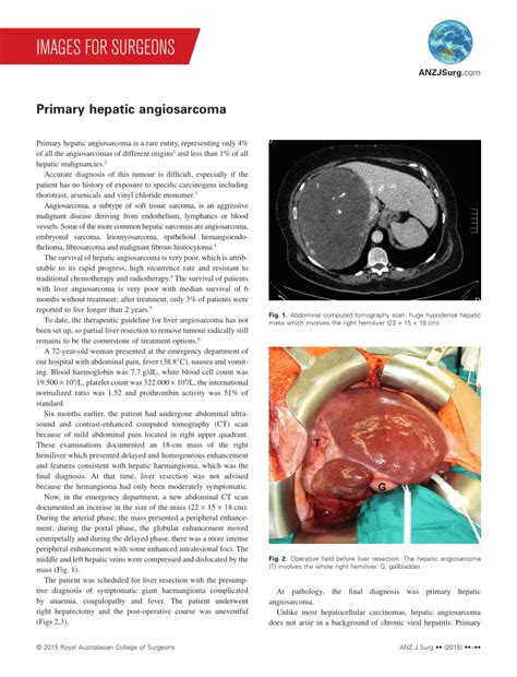 Pdf Primary Hepatic Angiosarcoma