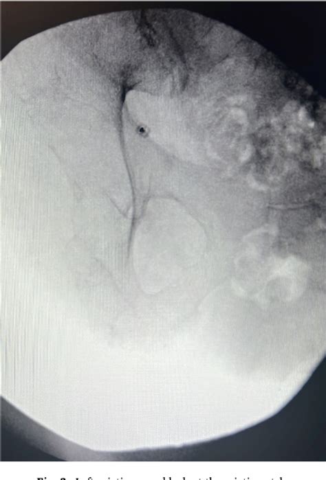 Figure 2 From Sciatic Nerve Radiofrequency Ablation For Phantom Limb