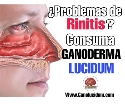 Ganoderma Vs Rinitis Ganoderma Lucidum