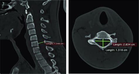 Measuring Sagittal And Transverse Diameters On CT Scan The Point And