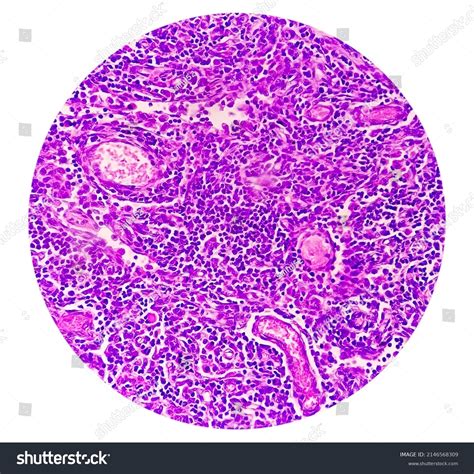 Photomicrograph Chronic Granulomatous Inflammation Cgi Tuberculosis