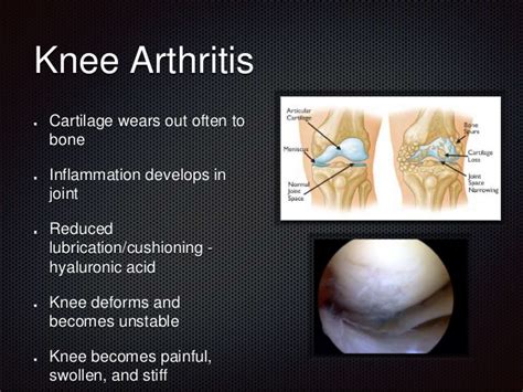 Knee Arthritis Causes Symptoms And Treatment Dr Kunal