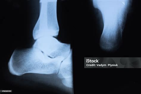 Calcaneus의 X선 스캔 또는 발뒤꿈치 뼈 파괴 발의 족근의 뼈 의학적 치료 개념 질병 인간 뼈의 진단 0명에 대한 스톡