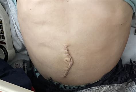 Incision From First Surgery Last Thursday Strictureplasty 7x Dilation