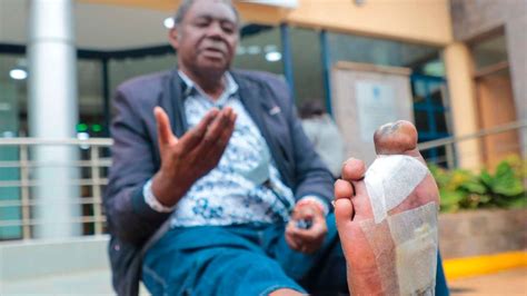 Lessons From Kenyans Who Are Facing Amputation Daily Nation