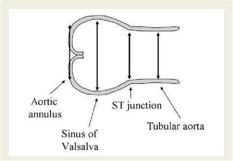 Typical Measurements Of The Aortic Root Apparatus St Sinotubular Download Scientific Diagram