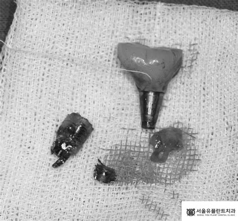 서울유플란트 치과 임플란트가 흔들려요feat 임플란트 픽스처 파절 어버트먼트 파절 네이버 블로그