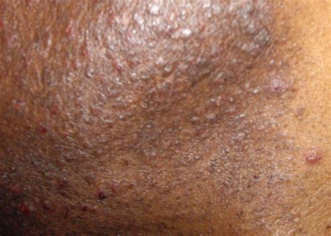 How To Prevent Razor Bumps On Neck My Beard Gang