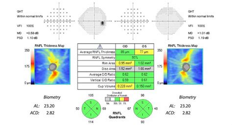 The Initial Visual Field A B And Optical Coherence Tomography Oct
