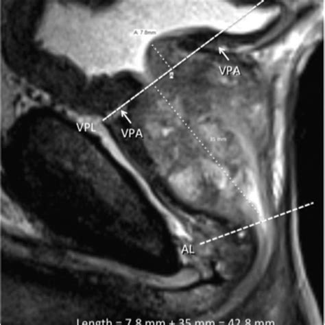 A Axial T2 Weighted Mri Structures Surrounding The Prostate That