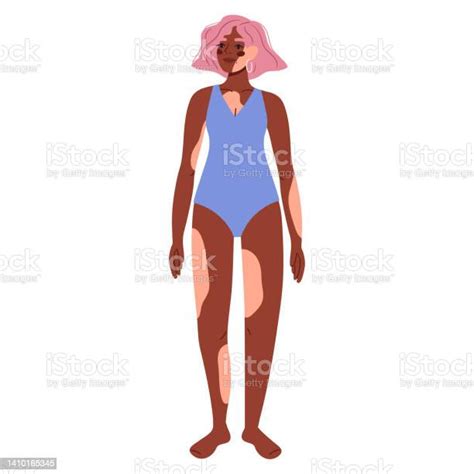 수영복에 피부 질환 Vitiligo를 가진 아프리카 계 미국인 여성 세계 Vitiligo 날 개념 자신을 받아들입니다 자기 사랑