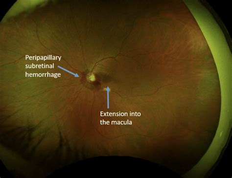 Retinal Review August 2022
