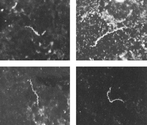 Syphilitic Lymphadenitis Basicmedical Key