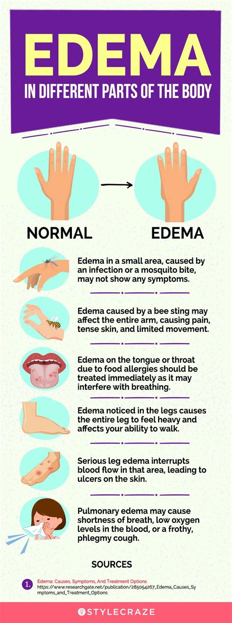 Pitting Edema What Is It Causes Grading Diagnosis 58 Off