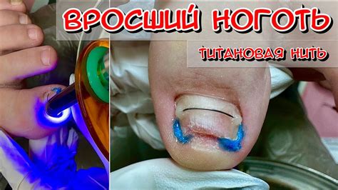 Вросший ноготь / Титановая нить / Скрученный ноготь / Вросший ноготь на ...