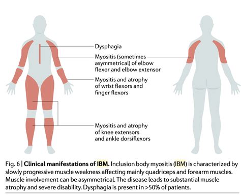 Inclusion Body Myositis Inflammatory Myopathies Practical Neurology