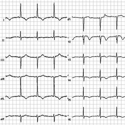 2 Ecg Signals Waveform 3 Download Scientific Diagram