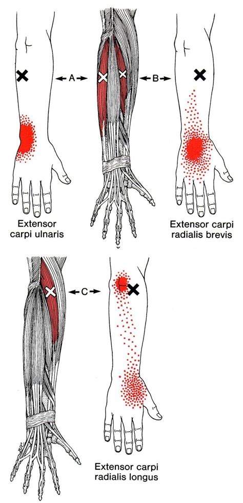 Pin By Jennifer Steffensen Kight On Trigger Points Trigger Points