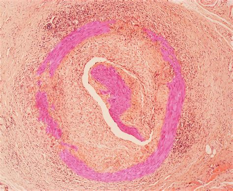 Temporal Ultrasound May Be Useful In Giant Cell Arteritis Disease