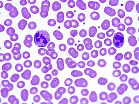 Two Segmented Neutrophil Granulocytes In A Blood Smear Under The