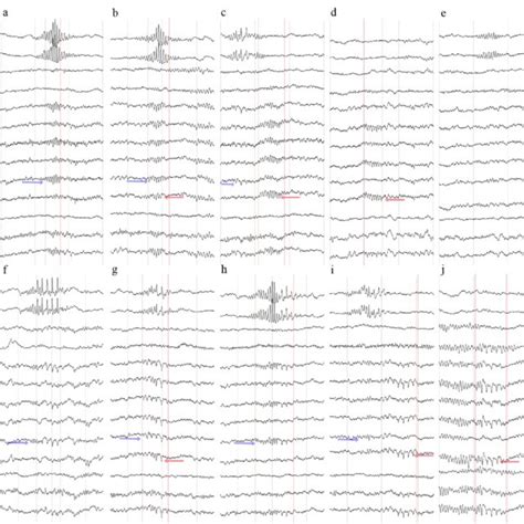 Pdf The Intracranial Correlate Of The 14and6sec Positive Spikes Normal Scalp Eeg Variant