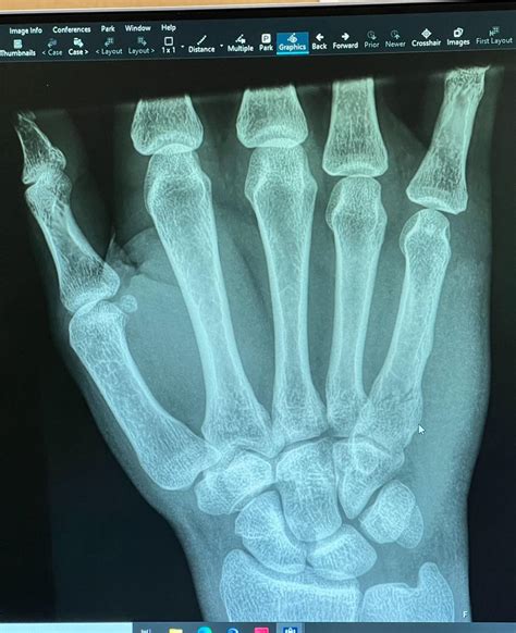 Metacarpal Fifth Proximal Rradiology