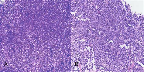 A Diffuse Type Lymphoid Cells With Multilobulated Nuclei Download Scientific Diagram A Diffuse Type Lymphoid Cells With Multilobulated Nuclei Download Scientific Diagram