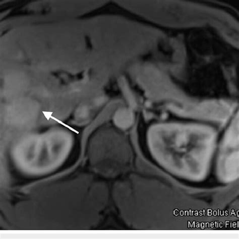 Mri Abdomen Case 1 Showing Numerous Dominant Li Rads 5 Lesions With Download Scientific