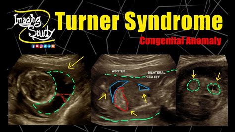 Fetal Ultrasound Hand Drawn Outline Doodle Icon Vector Image The Best