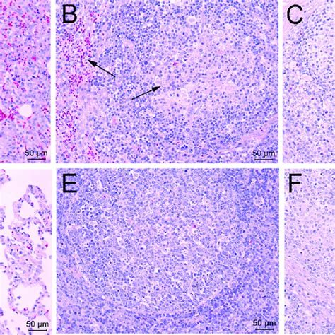 Typical Ihc Manifestations In The Lung A Lymph Node B And Tonsil