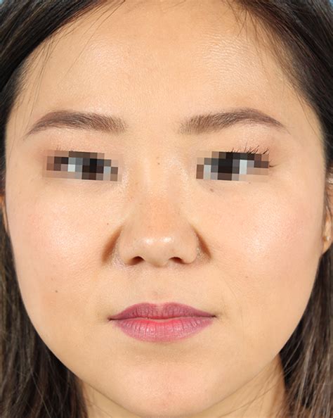 Non Surgical Rhinoplasty Dr Jeff Jumaily